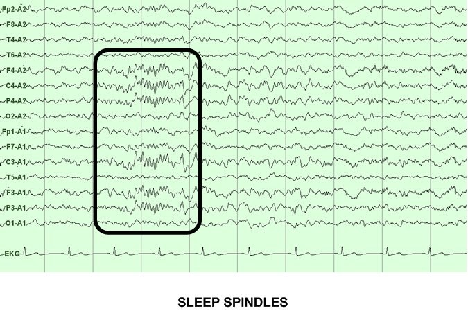 NEUROLOGY INVESTIGATIONS: ELEMENTS OF NORMAL SLEEP ACTIVITY - SLEEP ...