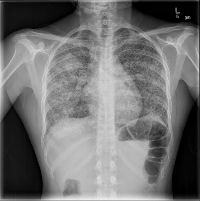 Post Gad: Lung CA with miliary lung mets