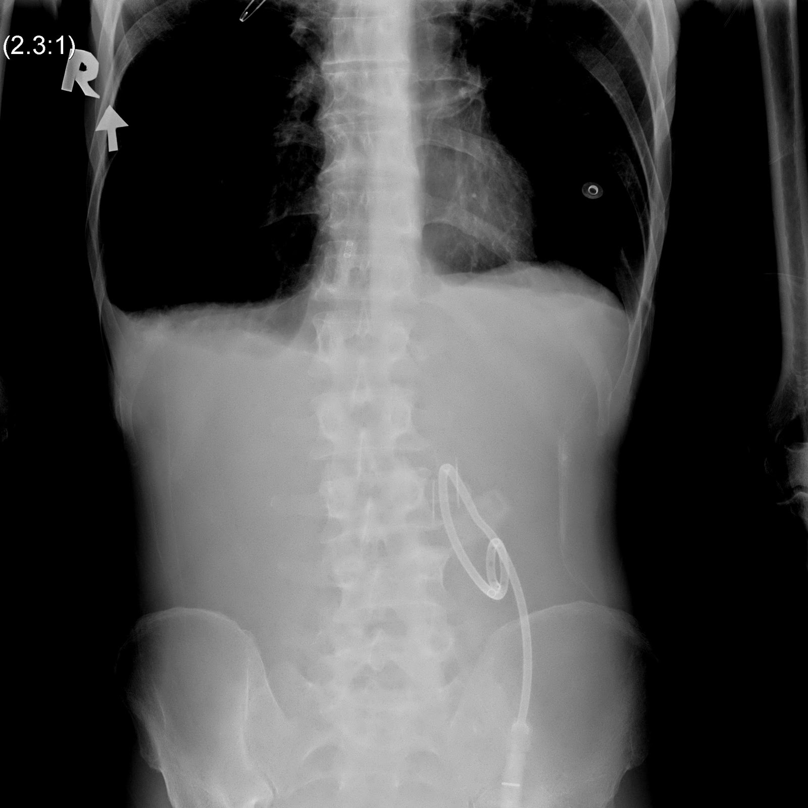 Post Gad: Gasless Abdomen