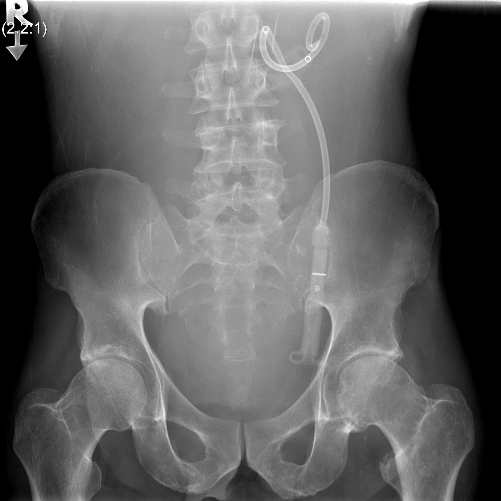 Post Gad: Gasless Abdomen