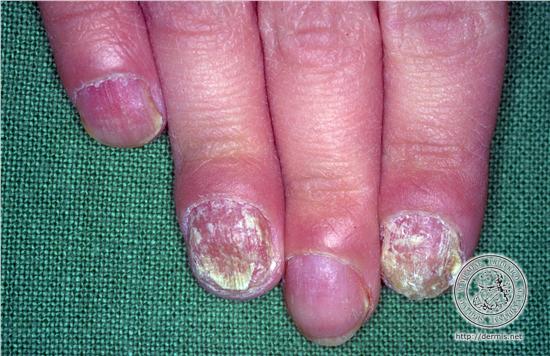 DRA. CYNTHIA FURTADO: Micoses nas unhas: como reconhecê-las?