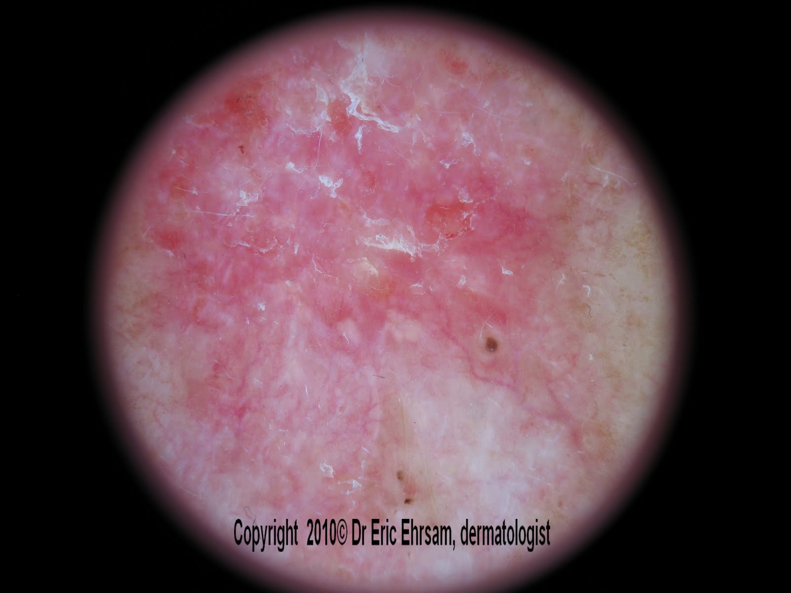 dermoscopy: Thin arborizing vessels