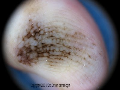 dermoscopy: Acral melanocytic nevus