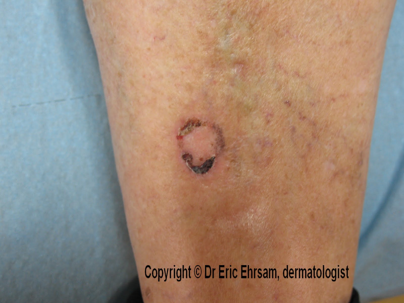 dermoscopy: What is this lesion on a leg (first case)