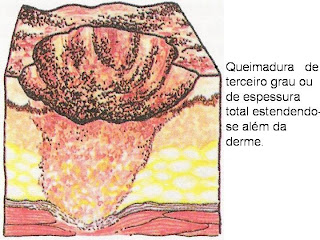Treinamento de Brigada: QUEIMADURAS