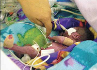 The Amazing Journey Of A 22 Weeker