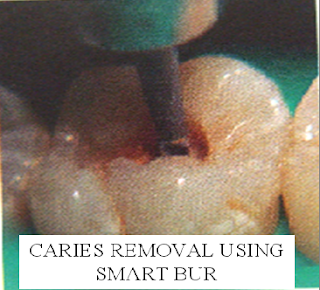 ONLINE DENTISTRY: SMART BUR 2