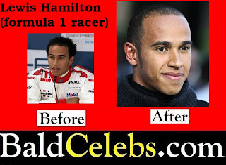 BaldCelebs.com: Lewis Hamilton (formula 1 racing chamption) Status: Balding