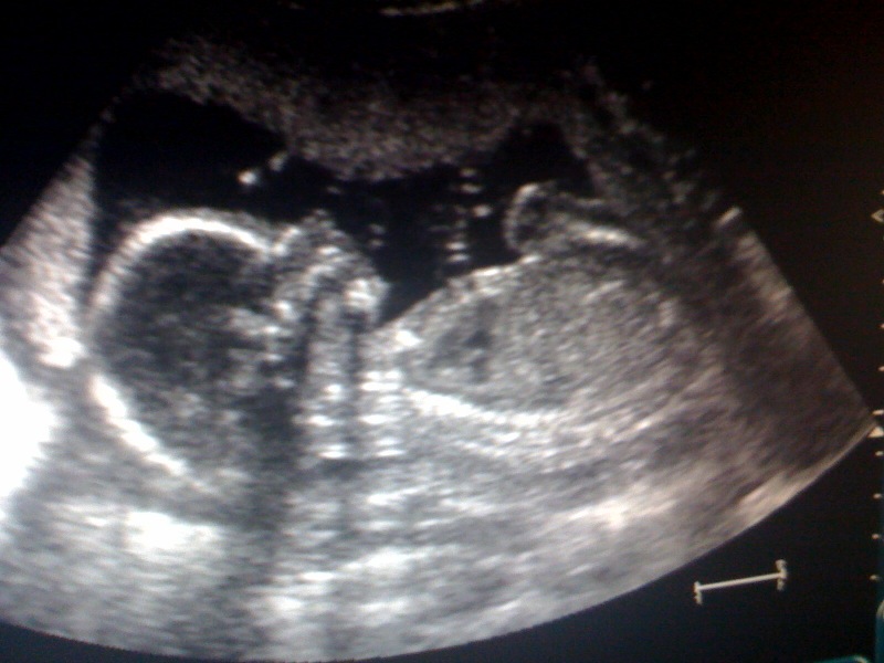 The Annett Family: 19 week Ultrasound