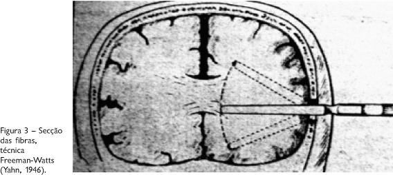 Lobotomia online: o que é uma lobotomia?