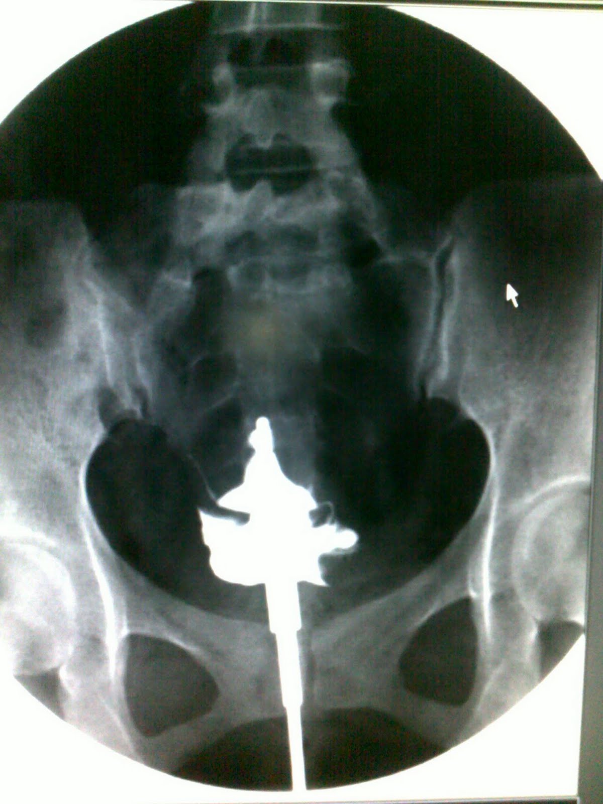 Cafe Radiologi: Teknik Radiografi HSG (Histerosalpingografi)