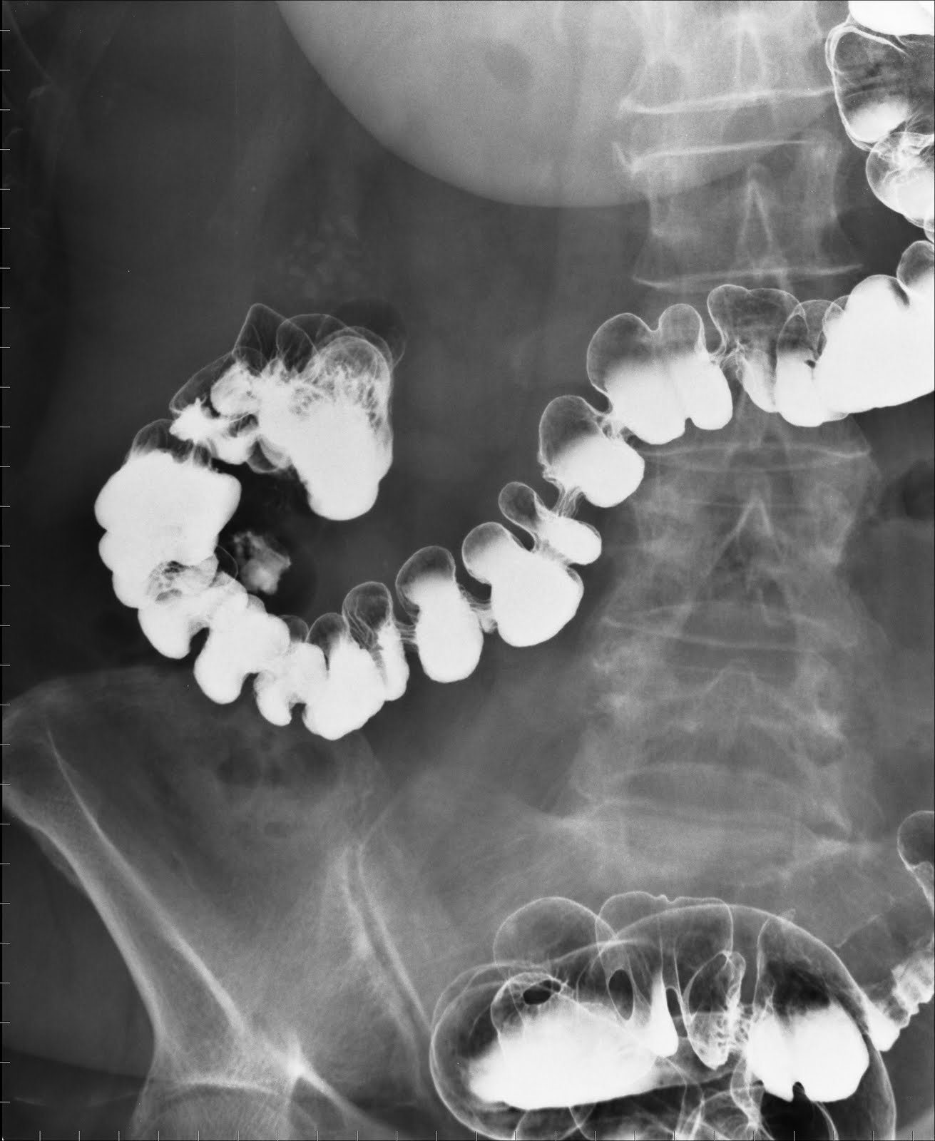 Cafe Radiologi: Teknik Pemeriksaan Kontras "Colon In Loop"