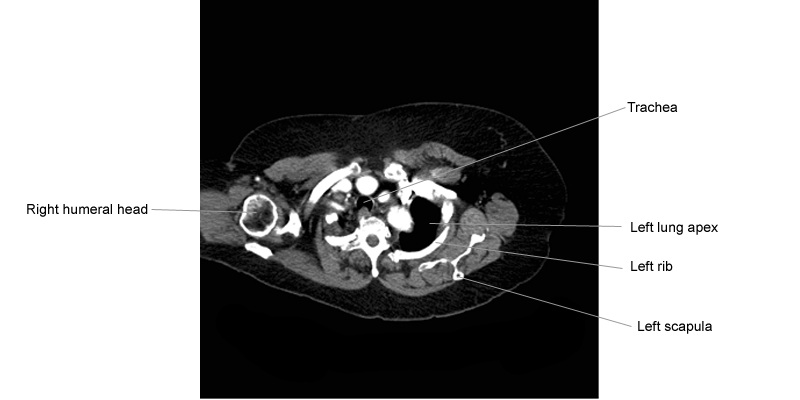 Hug Of Radiology: Anatomi dari gambaran CT Scan Thorax