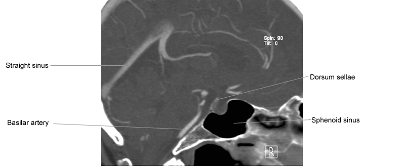Cafe Radiologi: Anatomi dari gambaran CT Scan Kepala