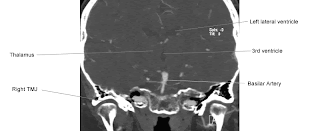 Cafe Radiologi: Anatomi dari gambaran CT Scan Kepala