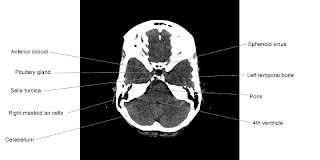 Cafe Radiologi: Anatomi dari gambaran CT Scan Kepala