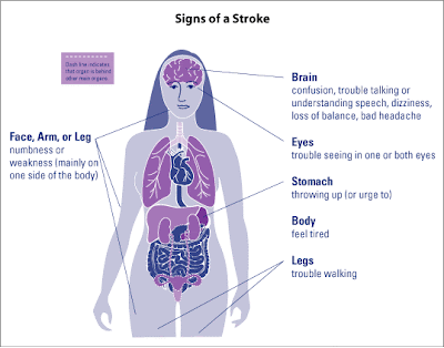 info STROKE: GEJALA, PENYEBAB DAN AKIBAT STROKE