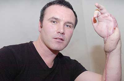 Nothing To Do With Arbroath: Carpenter sawed off his hand then picked it up