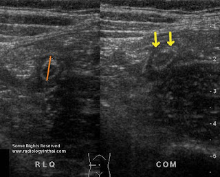 RiT radiology: Suspected Acute Appendicitis (5) - US Techniques