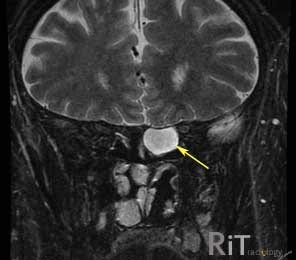 RiT radiology: Sphenoid Sinus Mucocele