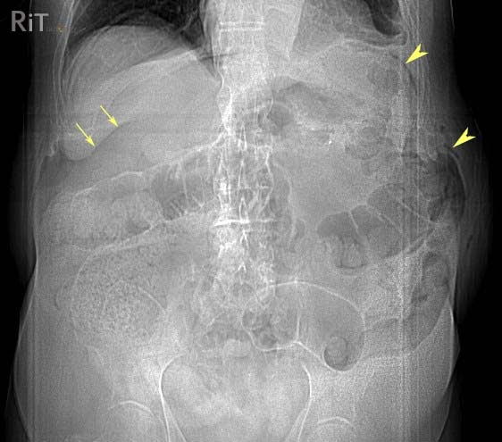 RiT radiology: Pneumoperitoneum: Right Upper Quadrant Features