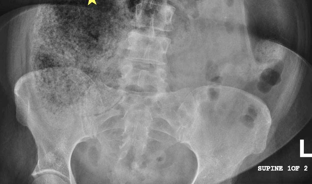 RiT radiology: Colonic Closed Loop Obstruction