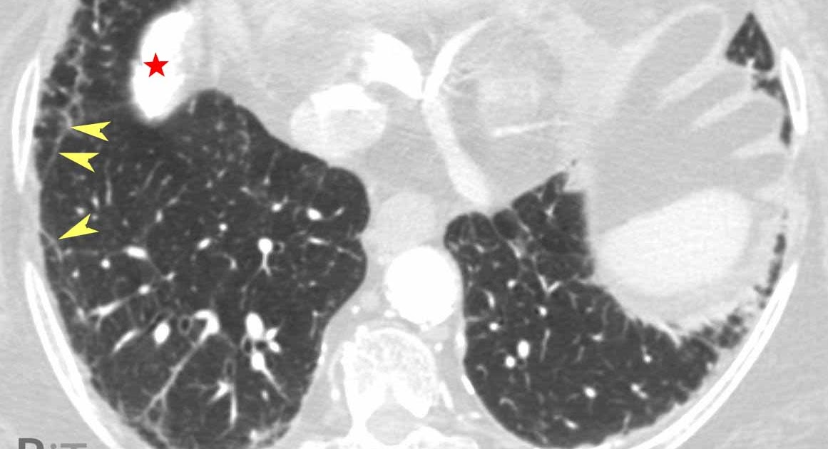 RiT radiology: Asbestosis