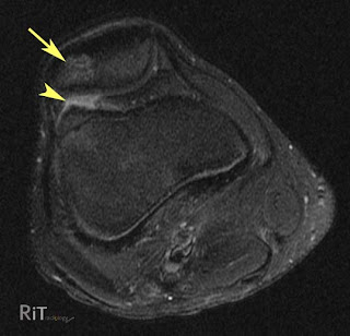 RiT radiology: Painful Bipartite Patella