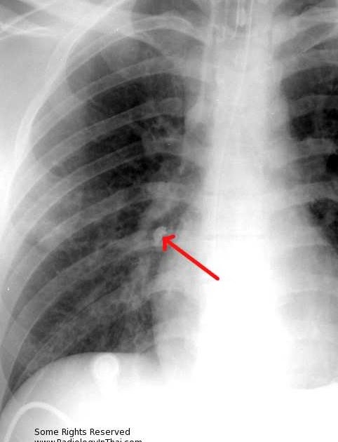 RiT radiology: Tooth Aspiration Following Facial Trauma