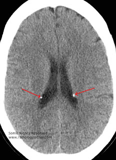 RiT radiology: Tuberous Sclerosis: Subependymal Nodules