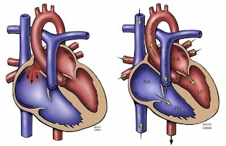 RiT radiology: ASD with PAPVR