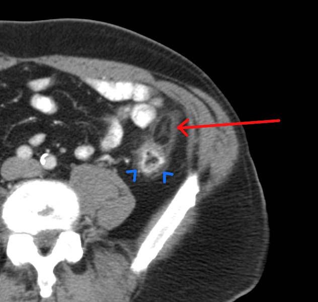 RiT radiology: Epiploic Appendagitis