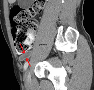 RiT radiology: Appendiceal Mucocele