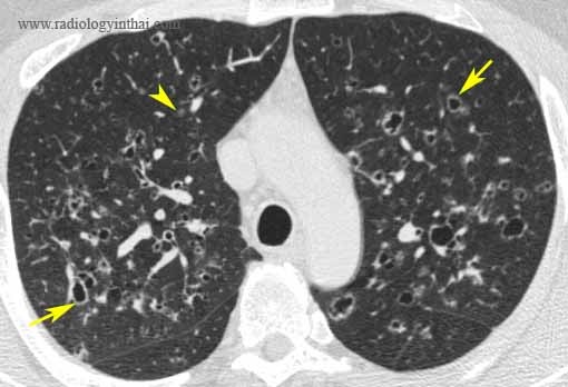 RiT radiology: Pulmonary Langerhans Cell Histiocytosis