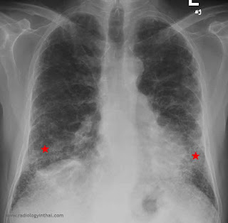 RiT radiology: Usual Interstitial Pneumonitis (UIP) Pattern