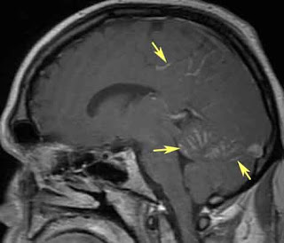 RiT radiology: Leptomeningeal Carcinomatosis