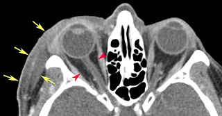RiT radiology: Preseptal Cellulitis