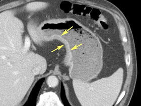 RiT radiology: Gastric Cancer on CT