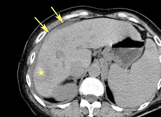 RiT radiology: Complications of Radiofrequency Ablation of Liver Tumors ...