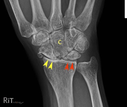 RiT radiology: Scapholunate Advanced Collapse (SLAC-wrist)