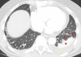 RiT radiology: Rounded Atelectasis