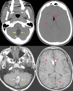 RiT radiology: Ruptured Intracranial Dermoid Cyst