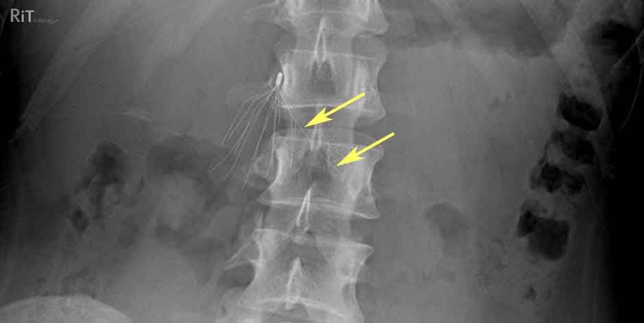 RiT radiology: Inferior Vena Cava (IVC) Filter Fracture