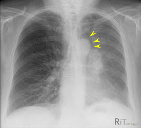 RiT radiology: The Luftsichel Sign