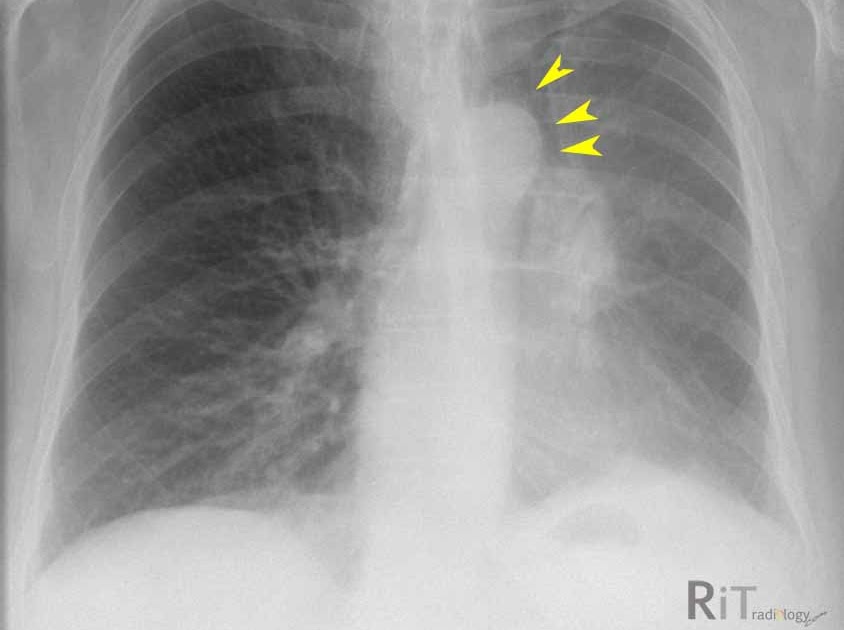 RiT radiology: The Luftsichel Sign