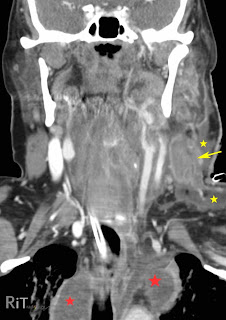 RiT radiology: Ludwig Angina