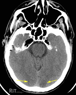 RiT radiology: Posterior Reversible Encephalopathy Syndrome (PRES)