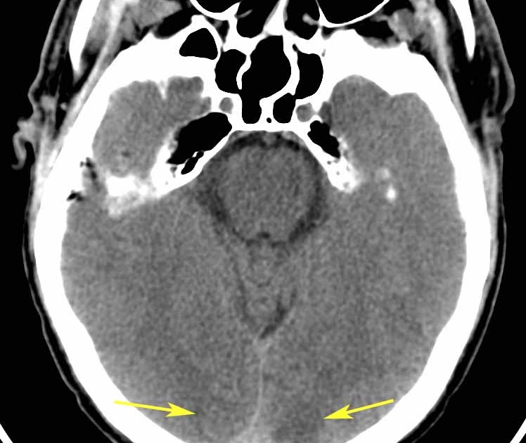 RiT radiology: Posterior Reversible Encephalopathy Syndrome (PRES)