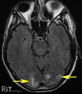 RiT radiology: Posterior Reversible Encephalopathy Syndrome (PRES)