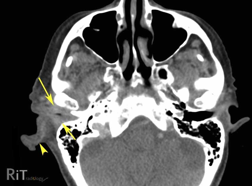 RiT radiology: Malignant Otitis Externa